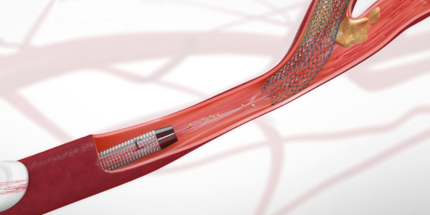 TransCarotid Artery Revascularization | Memorial Health System Health ...